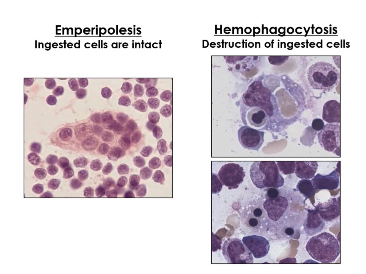 Rosai-Dorfman disease: Multiple painless lymphadenopathy Matted lymph ...