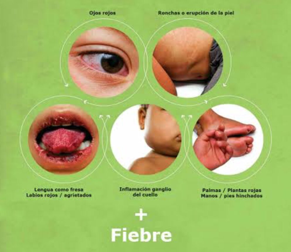 Enfermedad De Kawasaki Lengua De Fresa