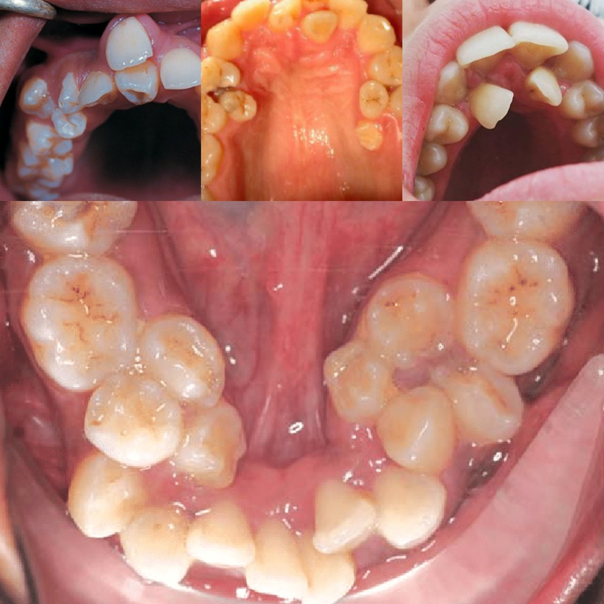 Hyperdontia Before And After