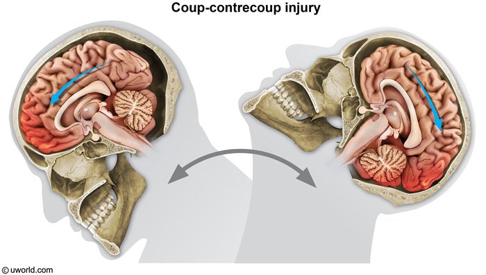 Coup Contrecoup Injury Symptoms