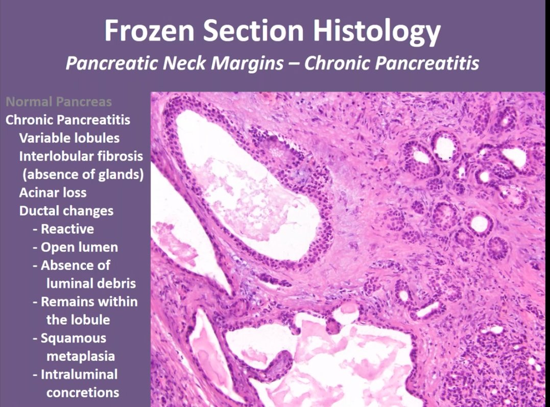 Chronic Pancreatitis Histology