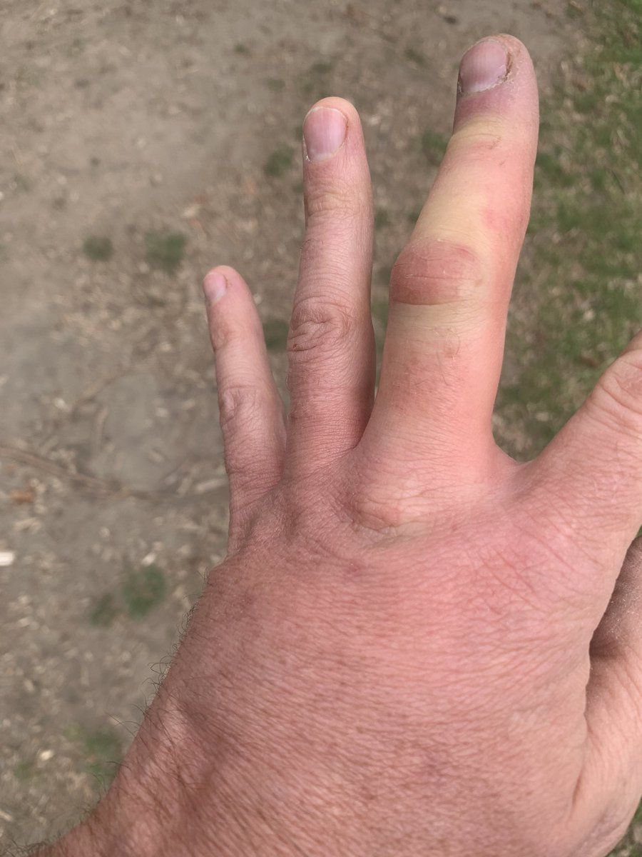 Wasp Sting On Finger