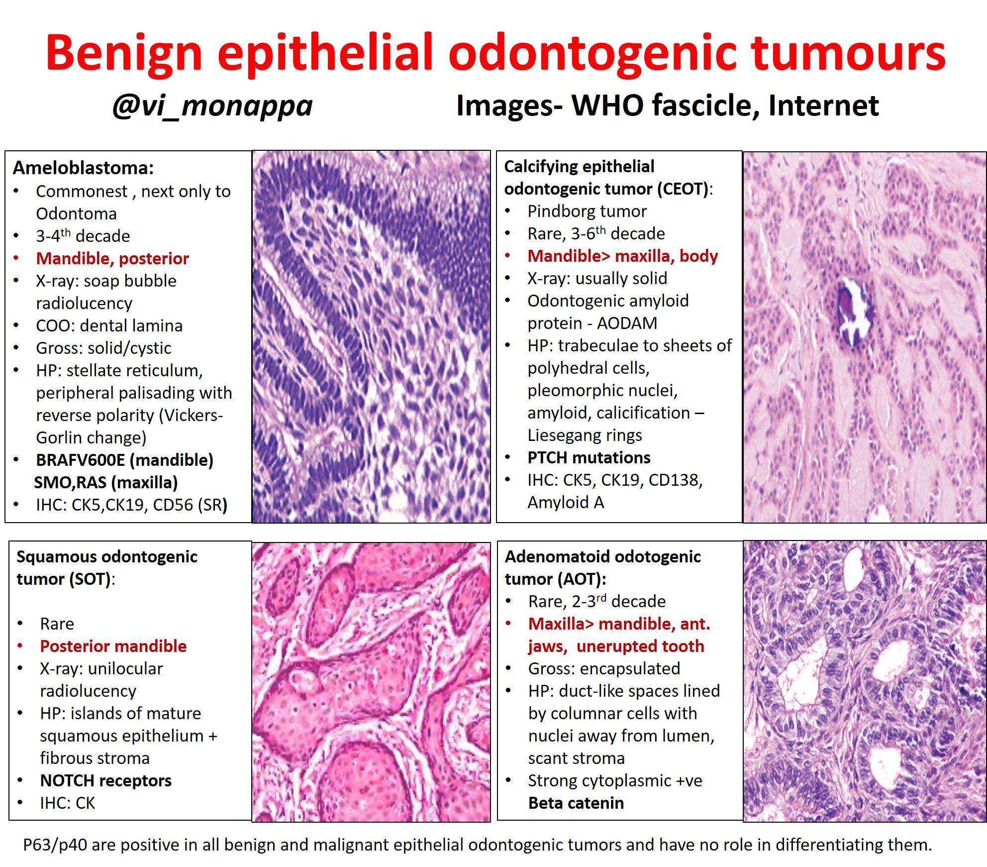 Calcifying Epithelial Odontogenic Tumor Histology Pathology Outlines