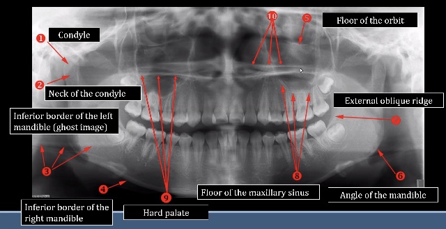 External Oblique Ridge