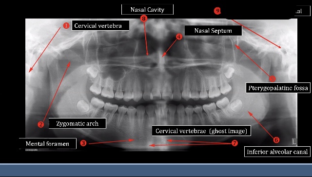 Mental Fossa Radiograph