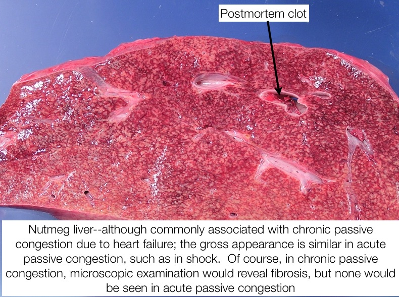 Nutmeg Liver Histology
