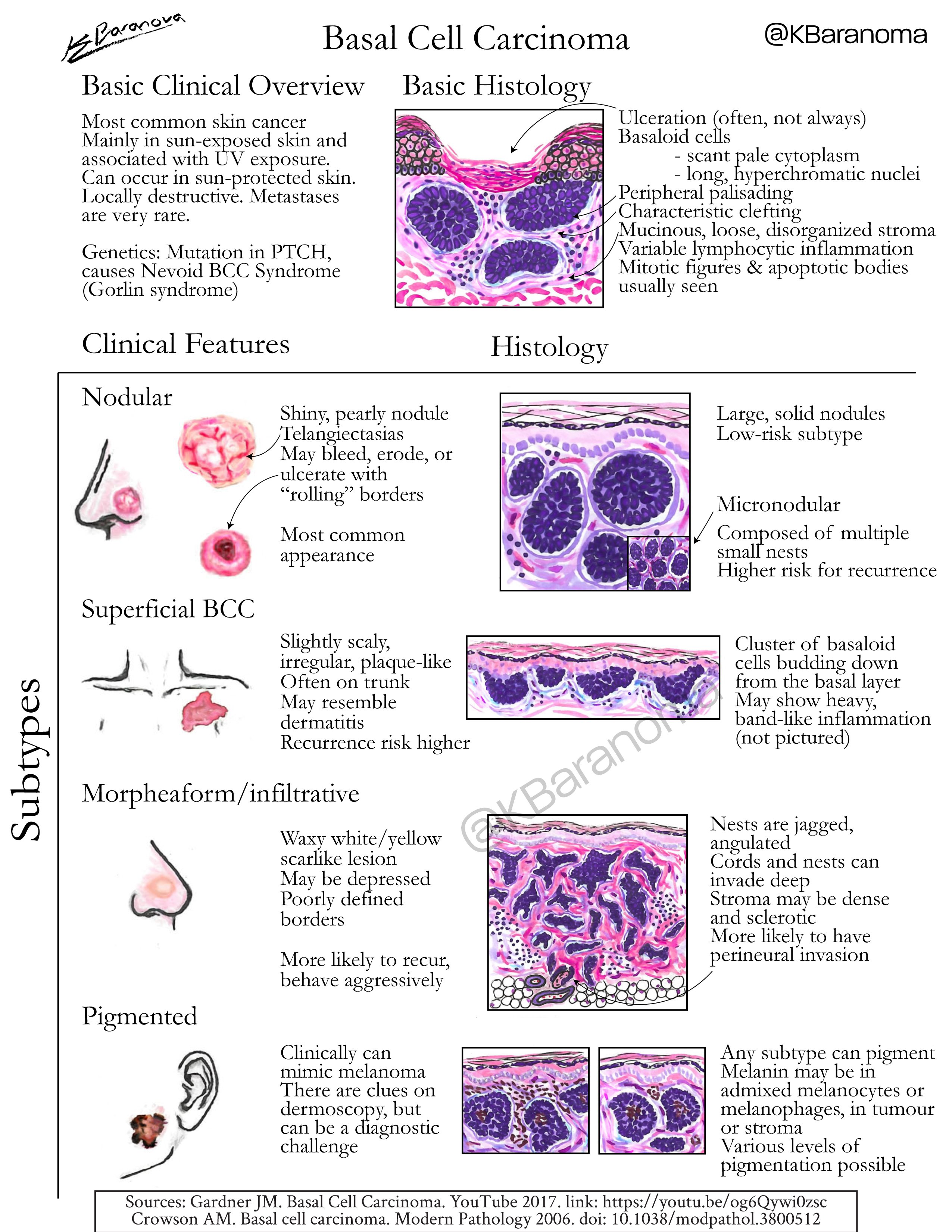 Nevoid Basal Cell Carcinoma Syndrome Histology