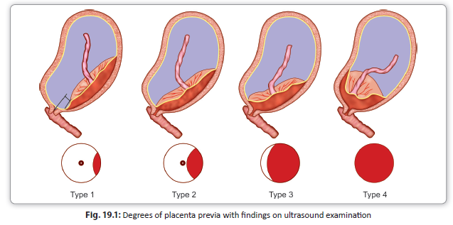 Placenta Previa Types