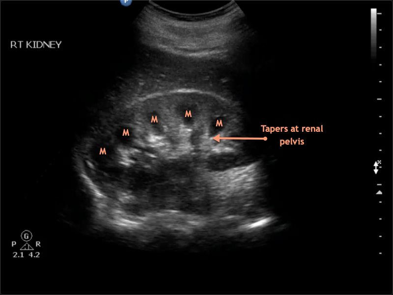 Normal Kidney Ultrasound