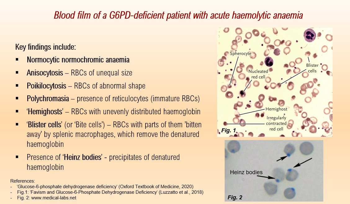 G6Pd Deficiency Heinz Bodies