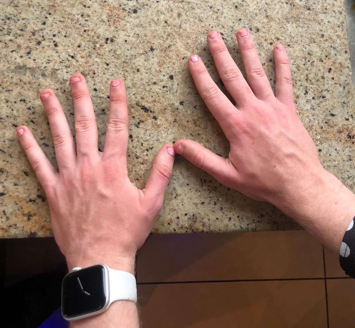 Shortest Fingernails In The World