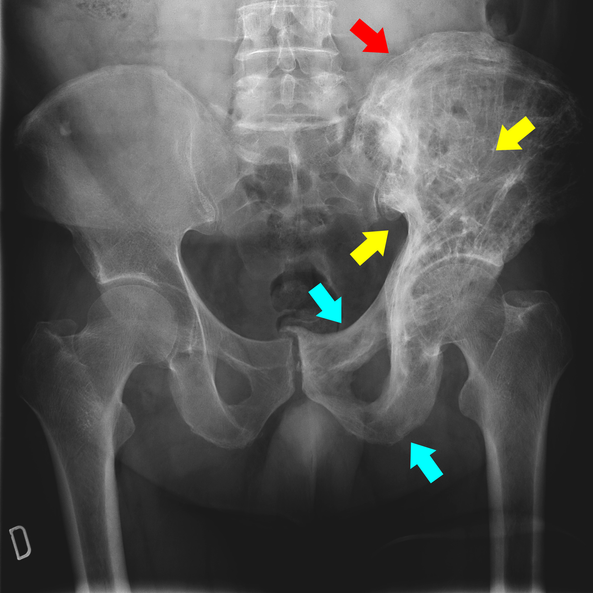 Pain Along Iliac Crest