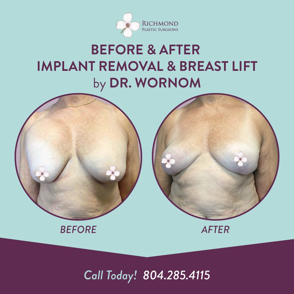 Large Silicone Implants Before And After Botched Season 4: Martina Big