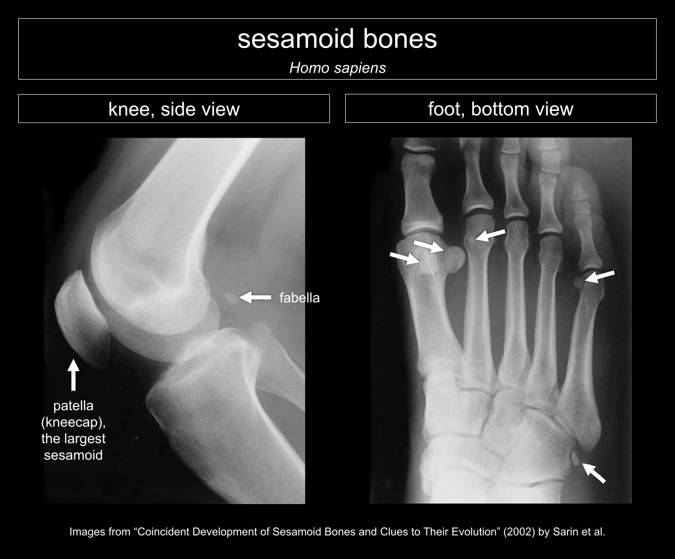 rebecca-hawkins-on-twitter-sesamoid-bones-are-bones-that-form-in