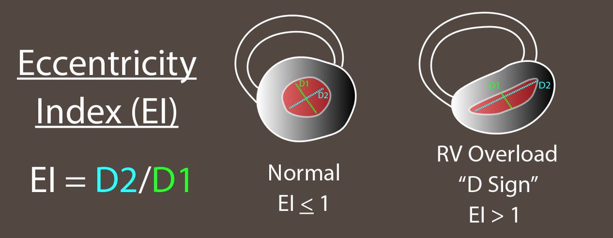 Now You May Have Heard of the "D Sign" on Ultrasound. But do you know ...