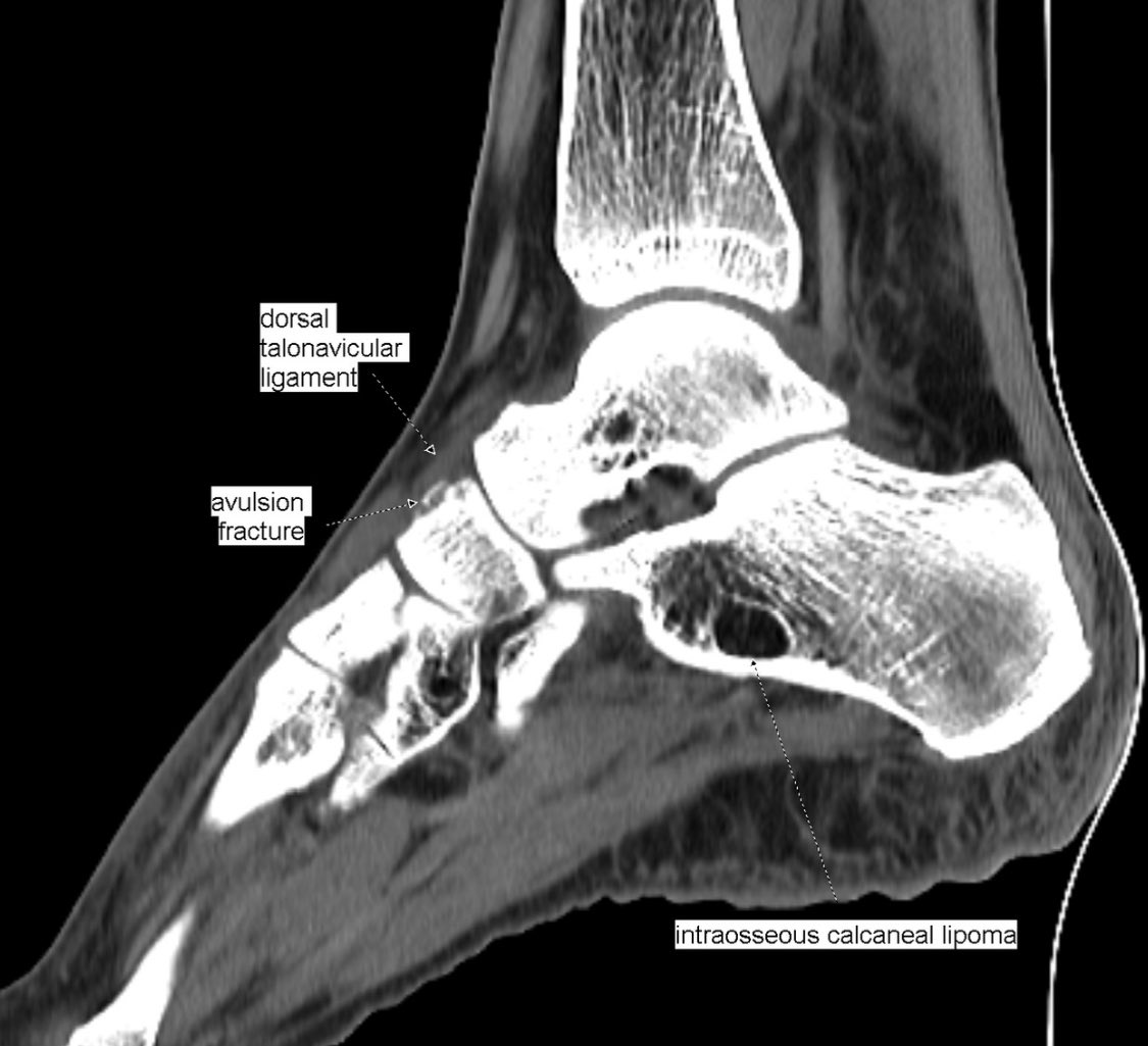 Dorsal Talonavicular Ligament