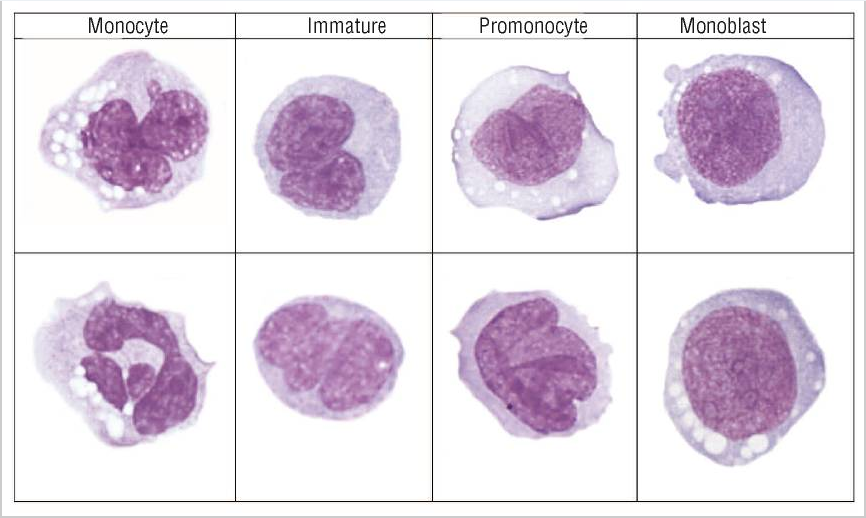 Muhammad Ahmad Md On Twitter Monocytes Vs Promonocytes Vs Monoblasts Monocyte Lacy