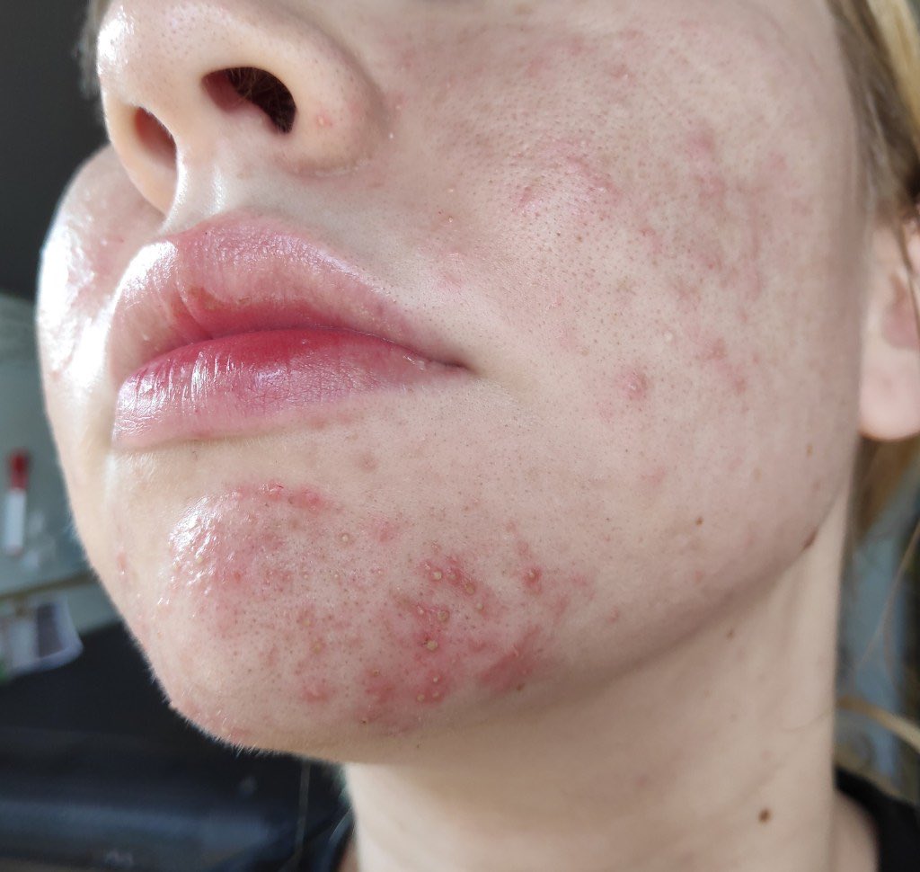 Malassezia Folliculitis, Furfur, Scalp Malassezia Yeast,, 54% OFF Malassezia Folliculitis, Furfur, Scalp Malassezia Yeast,, 54% OFF