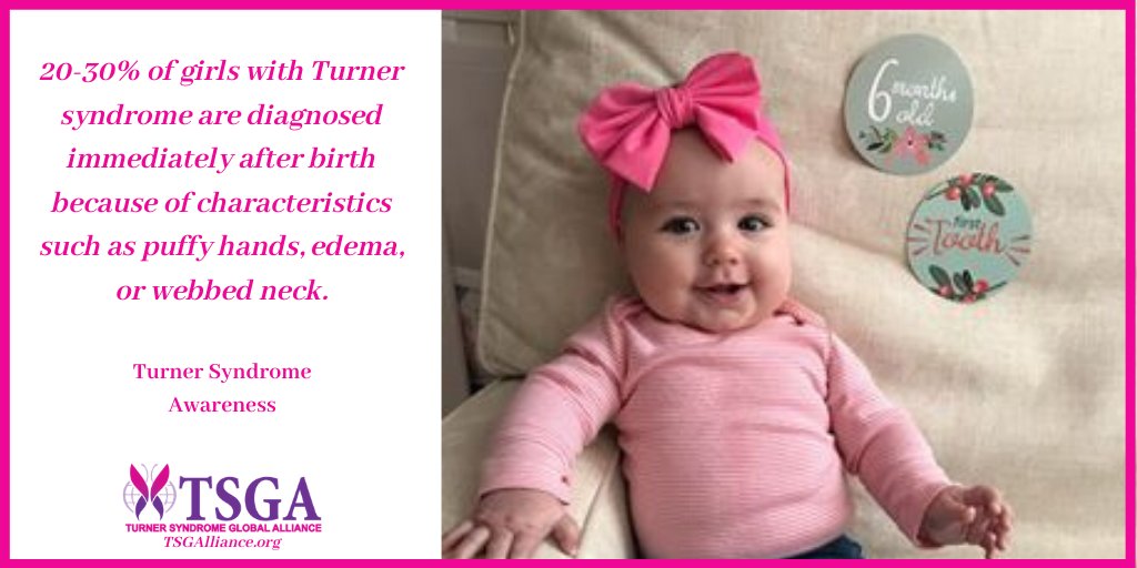 Turners Syndrome Baby
