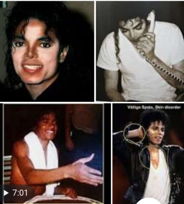 Michael Jackson Vitiligo Lupus