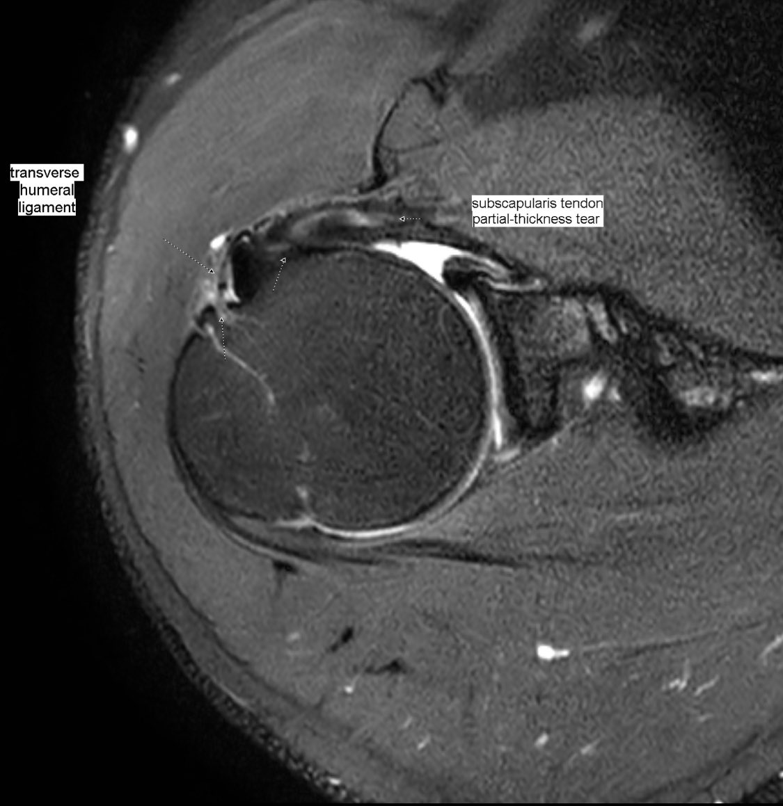 Transverse Humeral Ligament