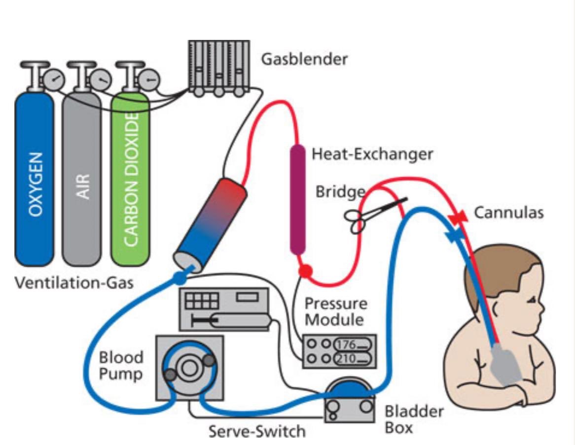 In this thread, we will talk about: Extracorporeal membrane oxygenation ...
