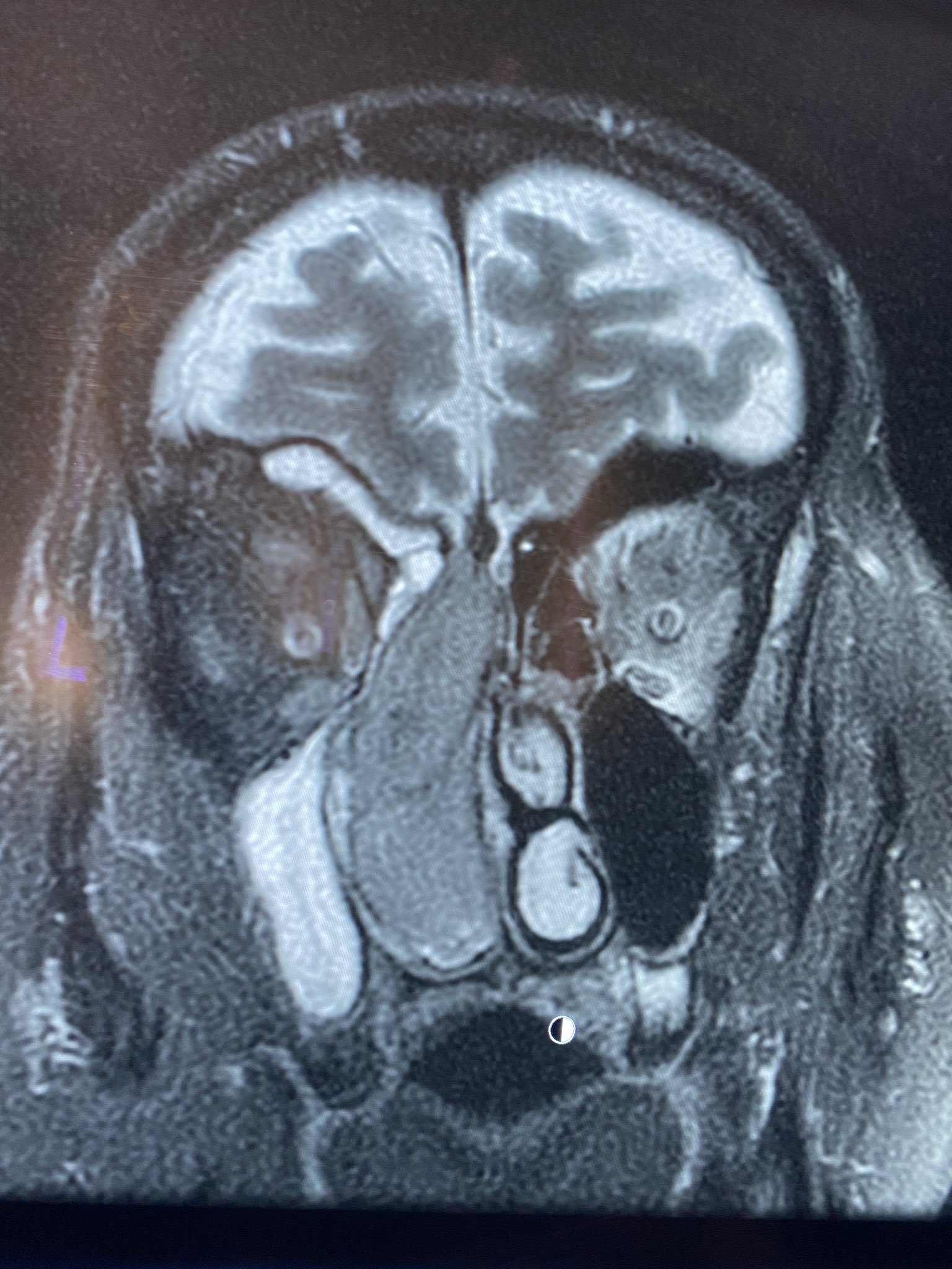 Cribriform Plate Mri