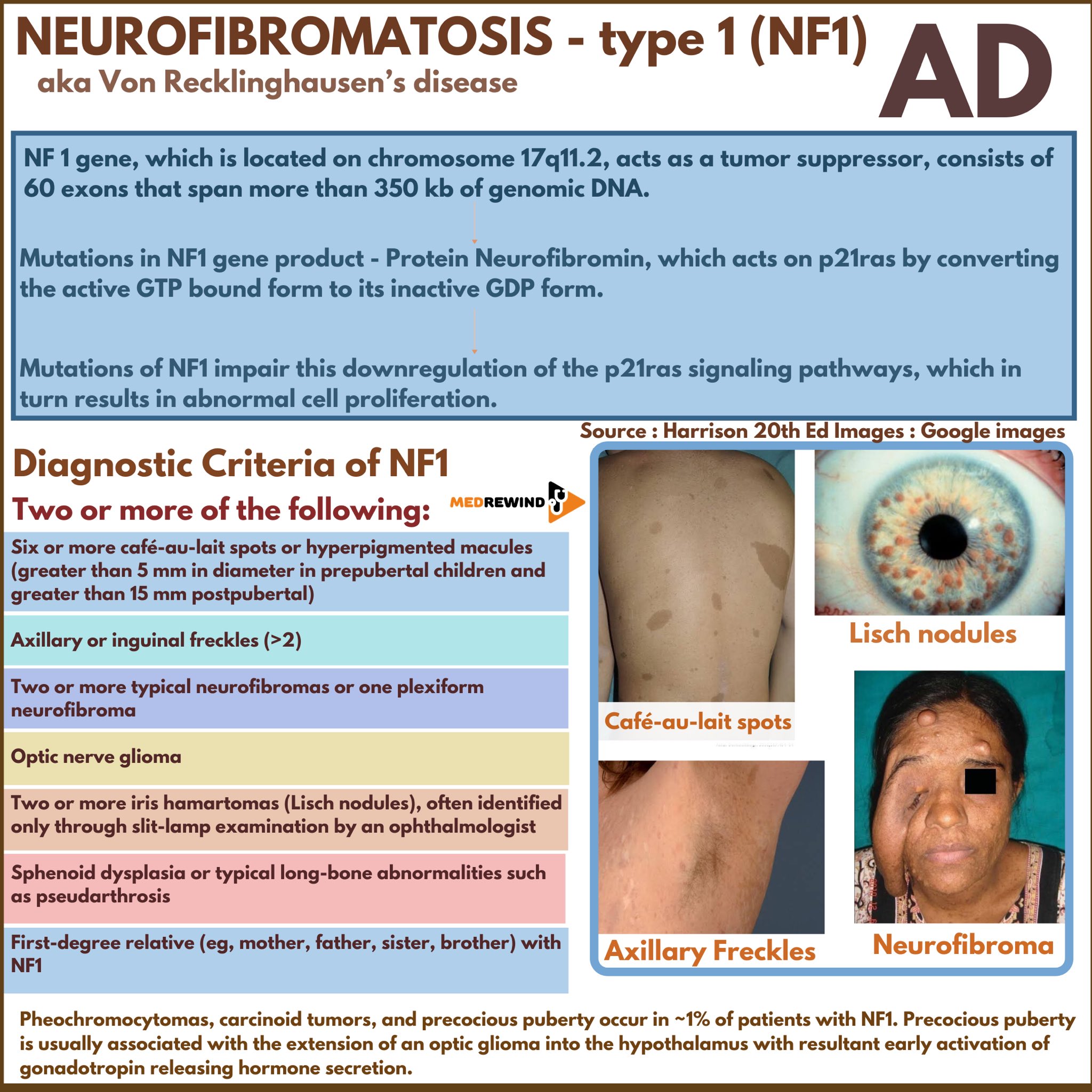 Neurofibromatosis Type 1 Lisch Nodules