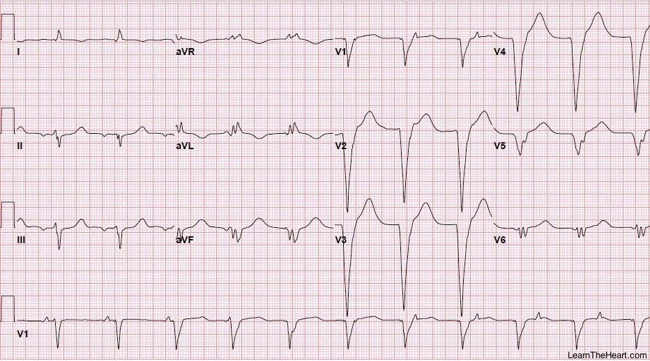 Idioventricular Rhythm