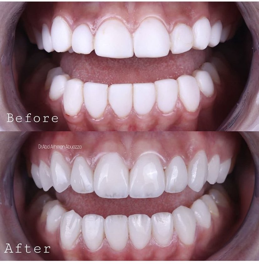 Bulky Veneers