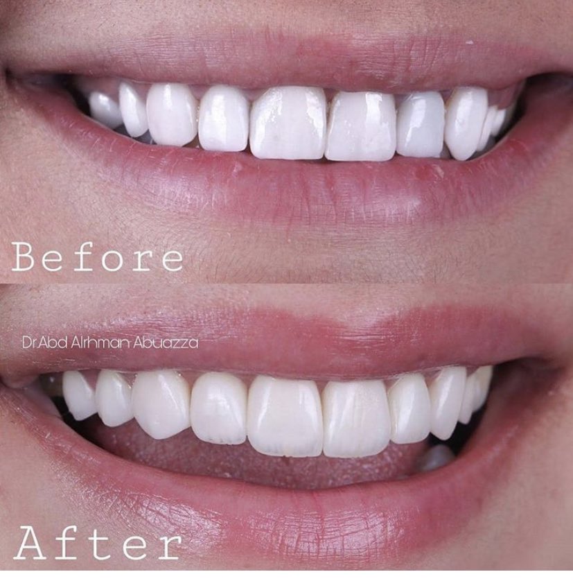 Bulky Veneers