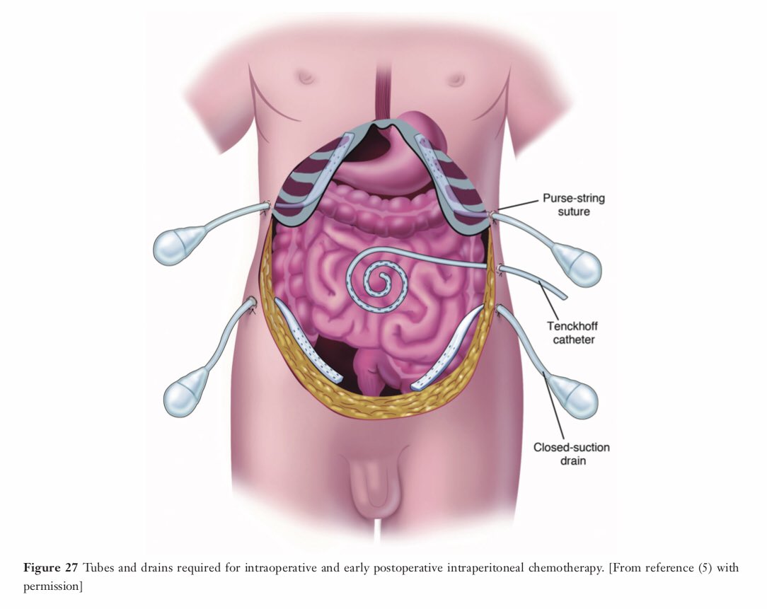 Intraperitoneal Drain