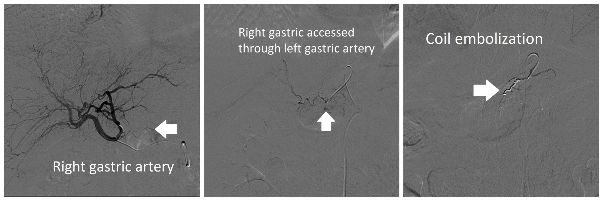 Left Gastric Artery Angiogram