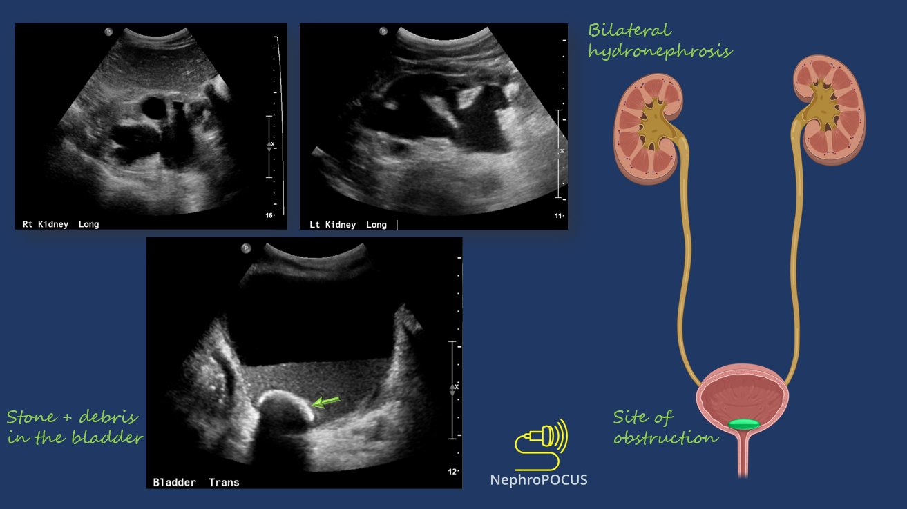 Bladder Stone Ultrasound