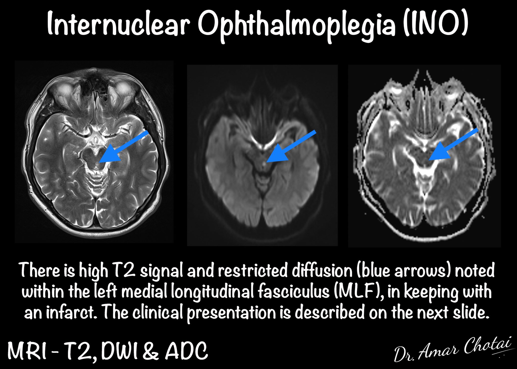 Medial Longitudinal Fasciculus Mri