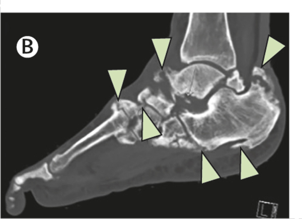 Roentgen Ray Reader Types Of Accessory Navicular Bones