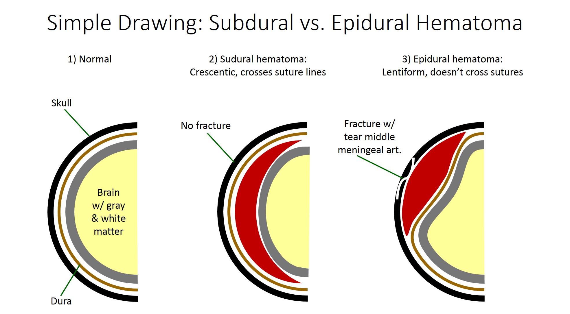 Epidural Hematoma Suture Lines