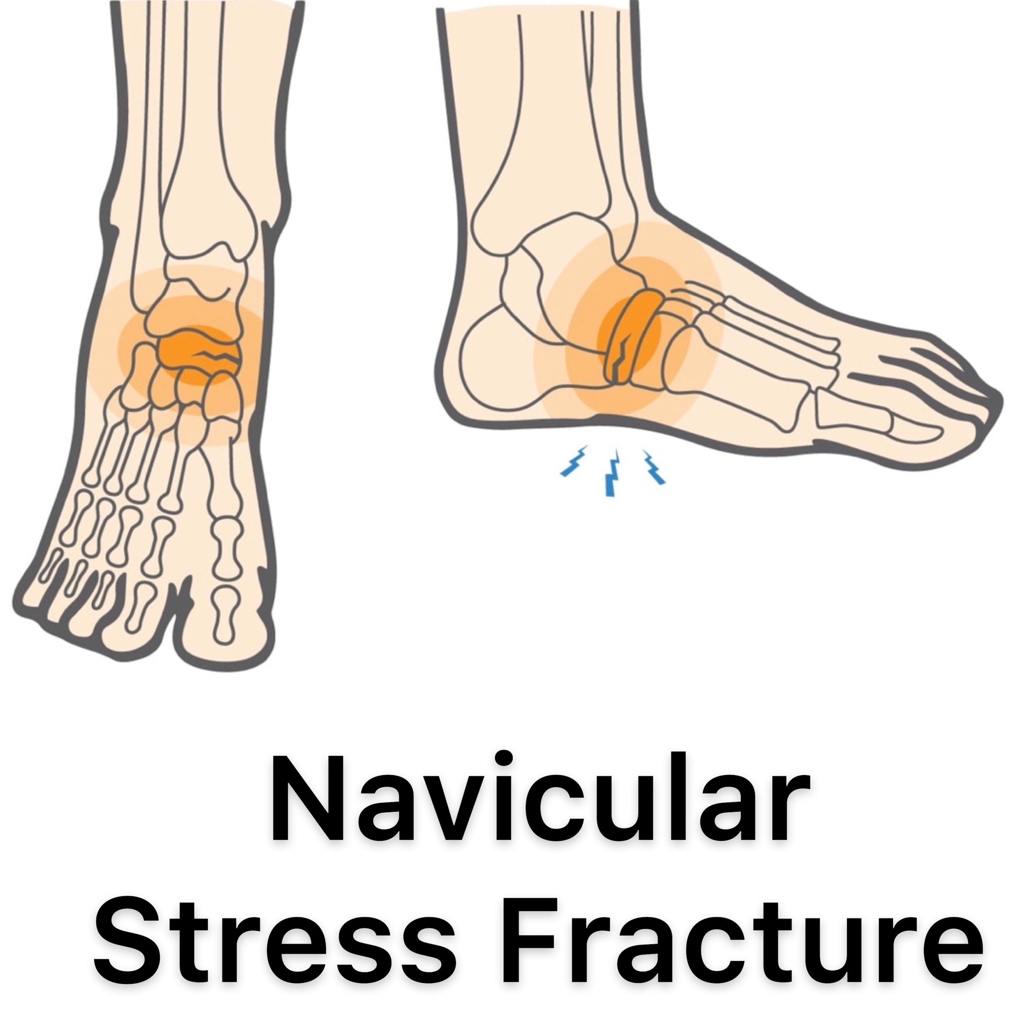 Navicular Stress Fracture Top Of Foot