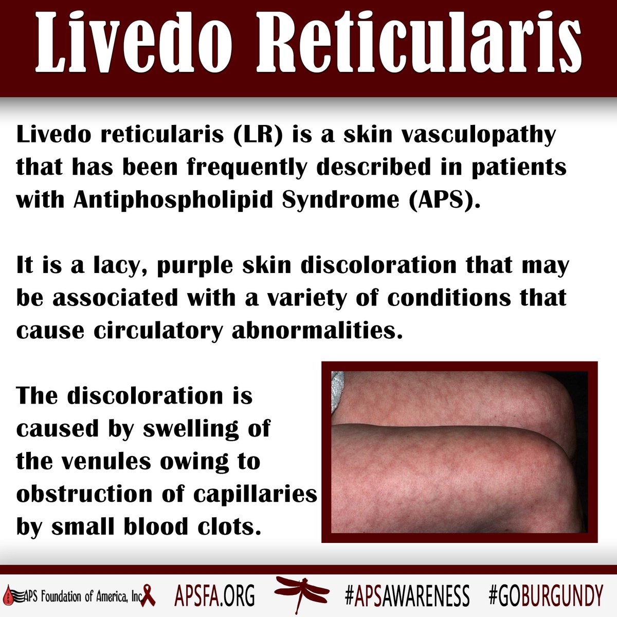 Livedo Reticularis Hands