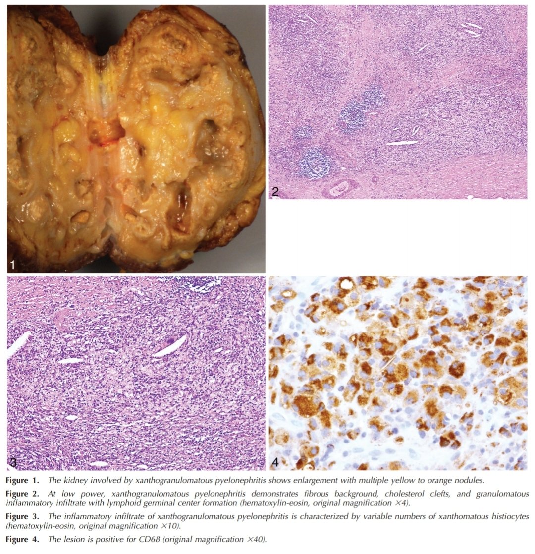 Xanthogranulomatous Pyelonephritis Histology