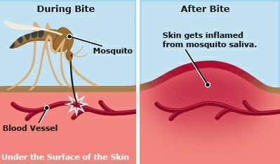 Mosquito Bite Diagram