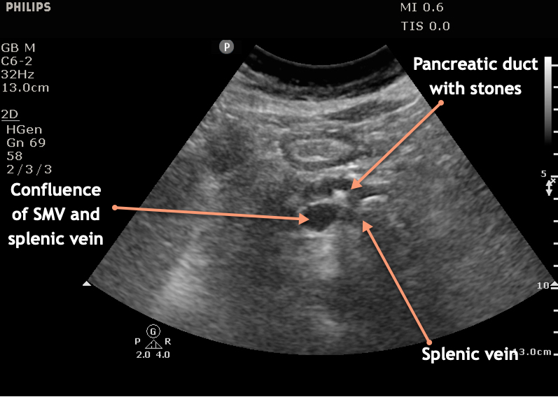 Pancreatic Duct Ultrasound