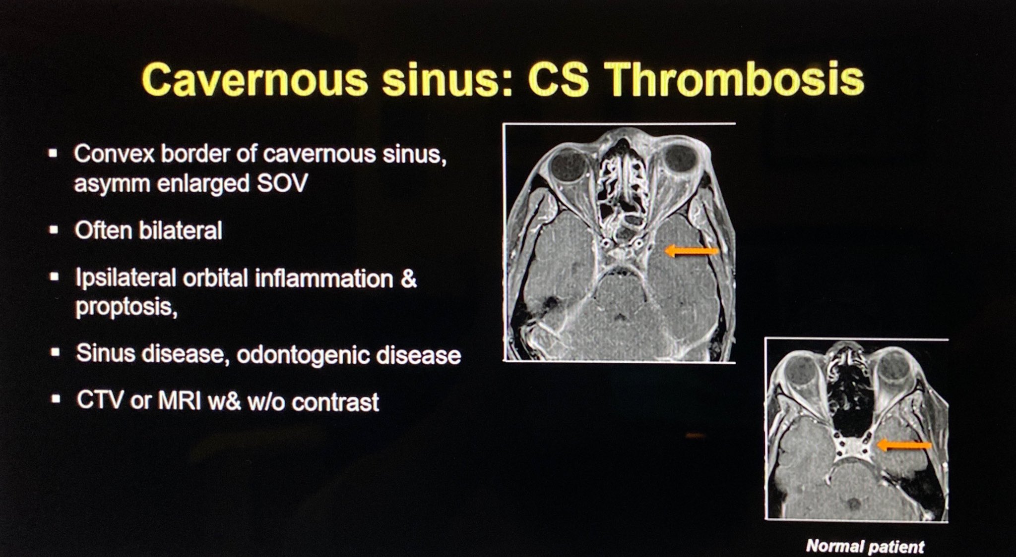 Cavernous Sinus Thrombosis Mri