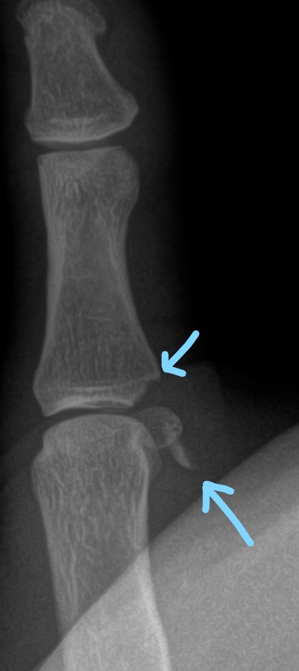 Gamekeepers Fracture