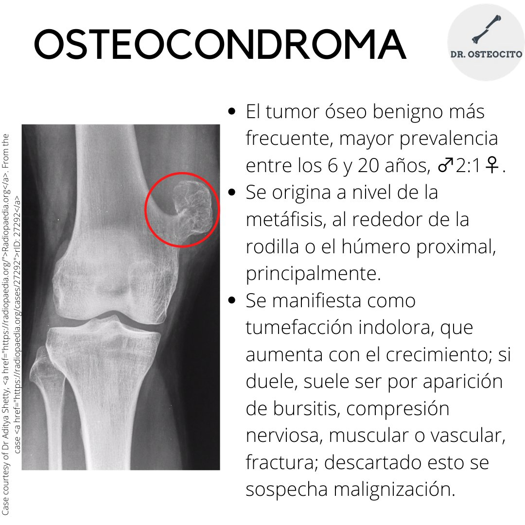 seno Fabricante rehén tratamiento para infarto oseo de rodilla ...