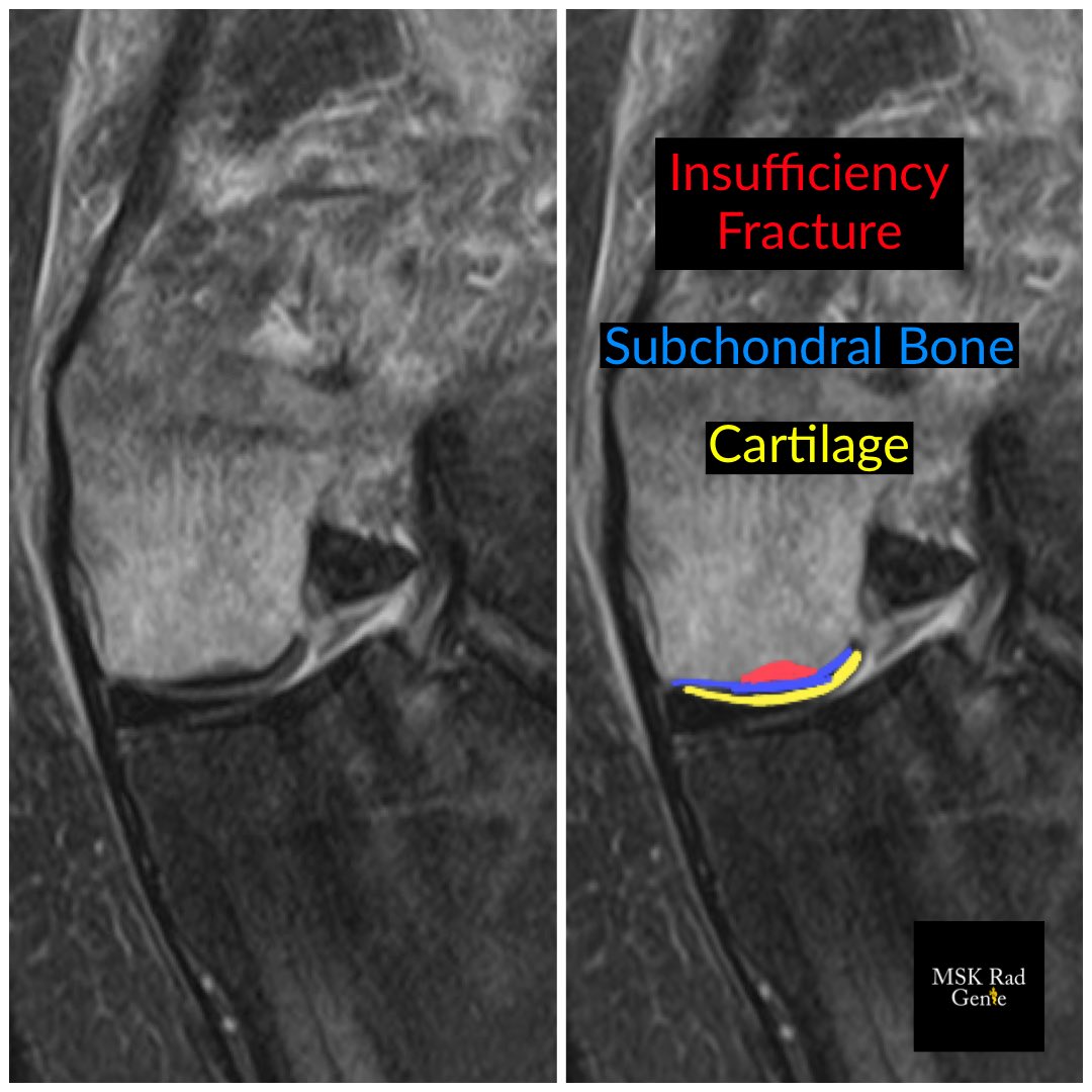 Knee Subchondral Stress Fracture