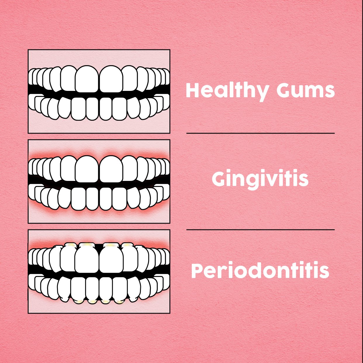 Healthy Gums