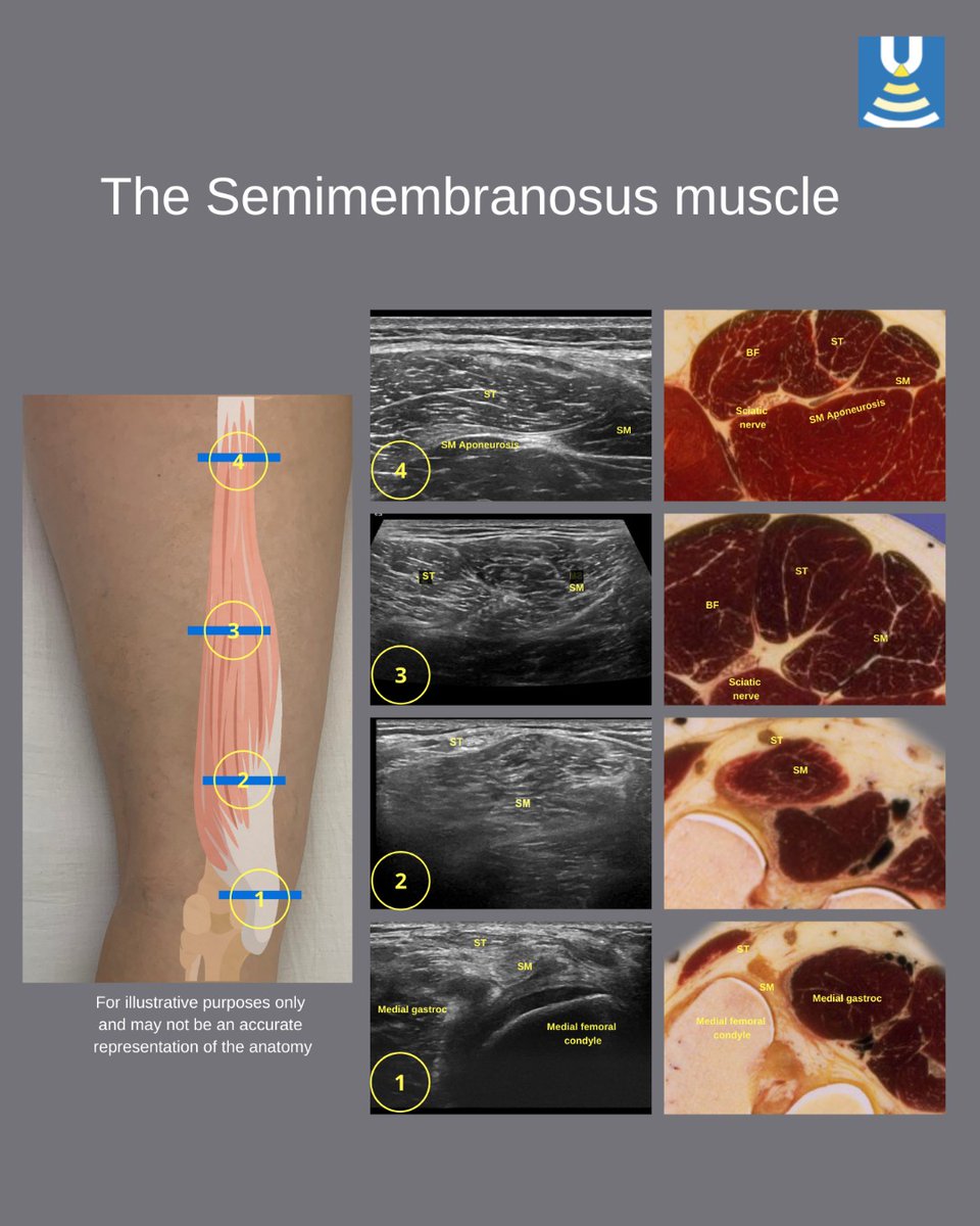 Hamstring Muscles Anatomy Ultrasound