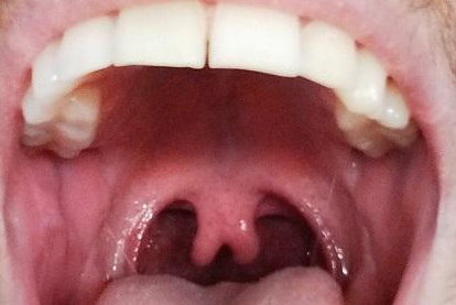 Split Uvula Syndrome Swollen Uvula: Causes, Symptoms, And Remedies