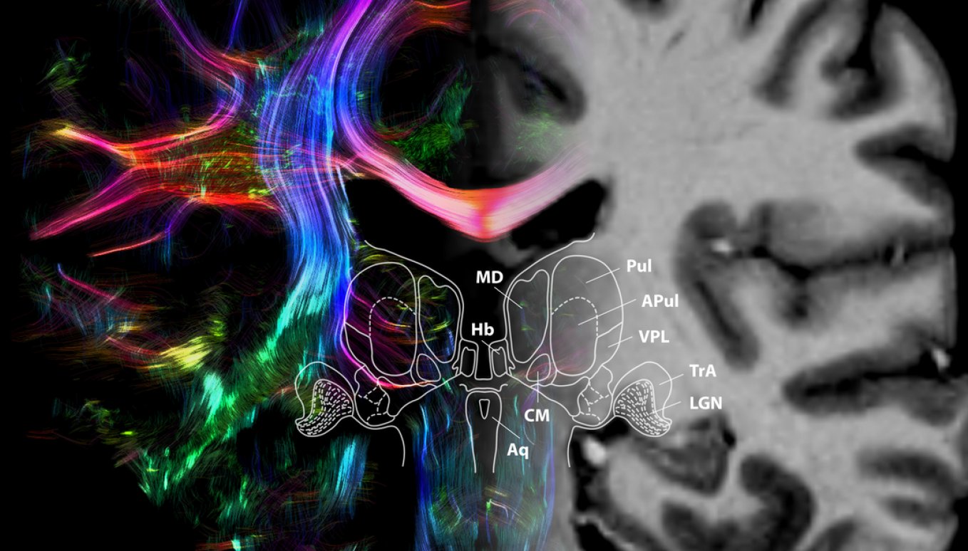 Medial Geniculate Nucleus Mri